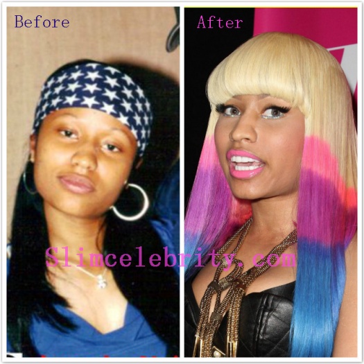 Skin Bleaching Before And After Nicki Minaj Skin Bleaching Before And After Nicki Minaj